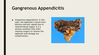 Acute appendicitis .pptx