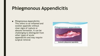 Acute appendicitis .pptx