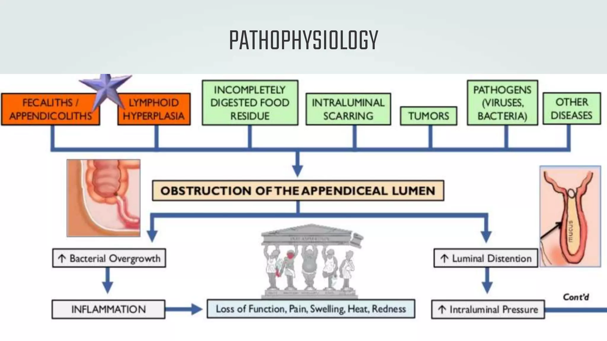 Acute appendicitis and Acute Abdominal Pain | PPT