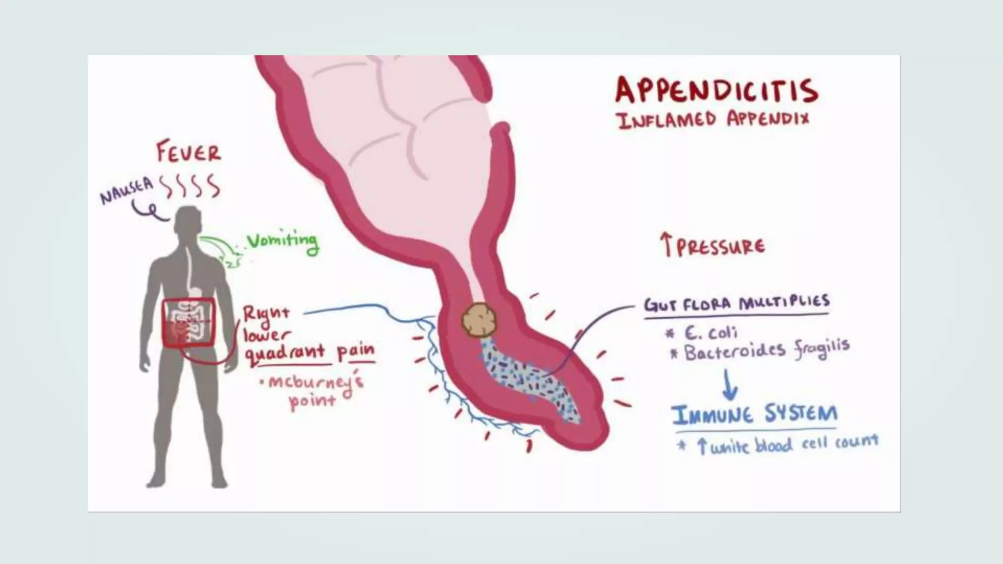 Acute appendicitis and Acute Abdominal Pain | PPT