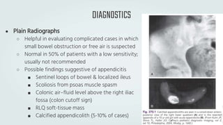 Sentinel Loop Appendicitis