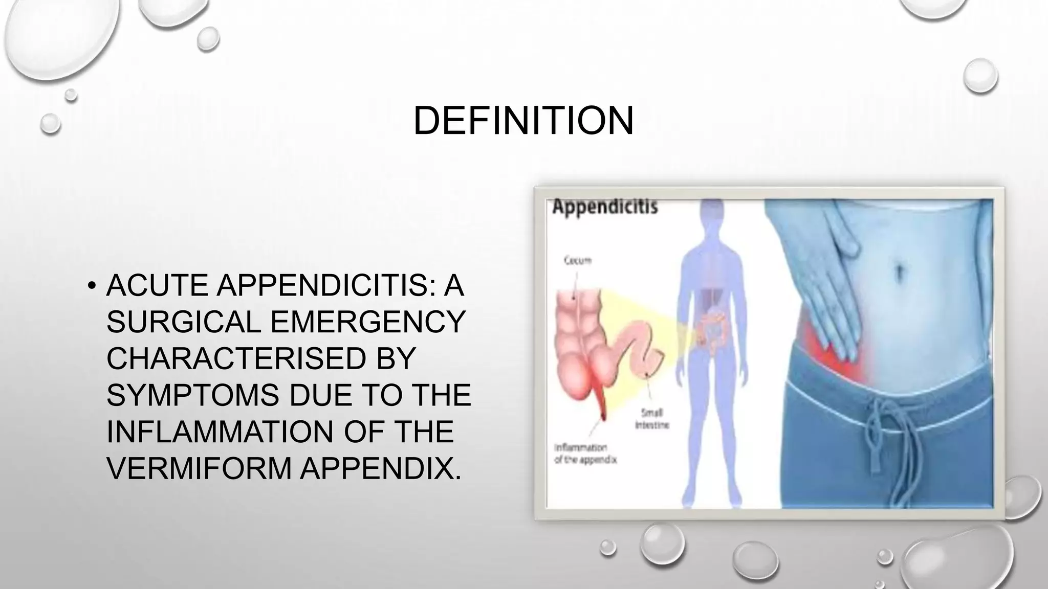 Acute appendicitis easy to diagnose | PPT