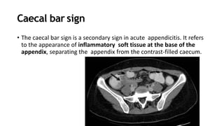 acute appendicitis final.pptx