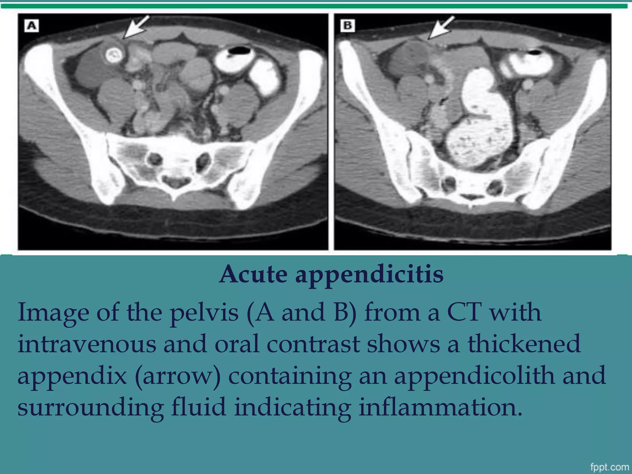 Acute appendicitis in adults - Hoang Cuong HMU | PDF | Digestive ...