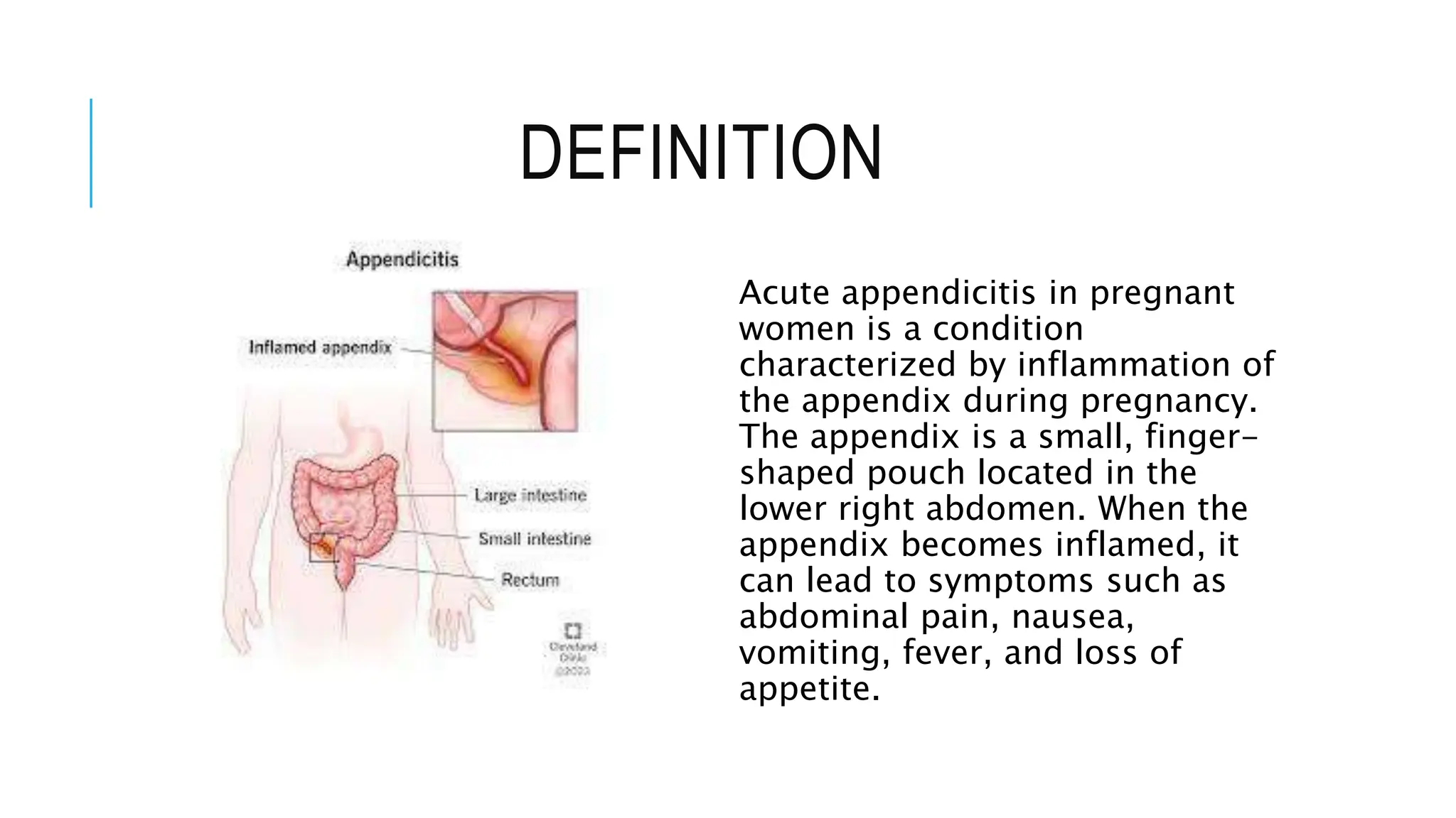 ACUTE APPENDICITIS IN A PREGNANT WOMAN.pptx