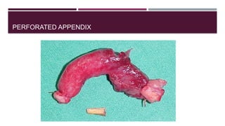 acute appendicitis in children etio.pptx
