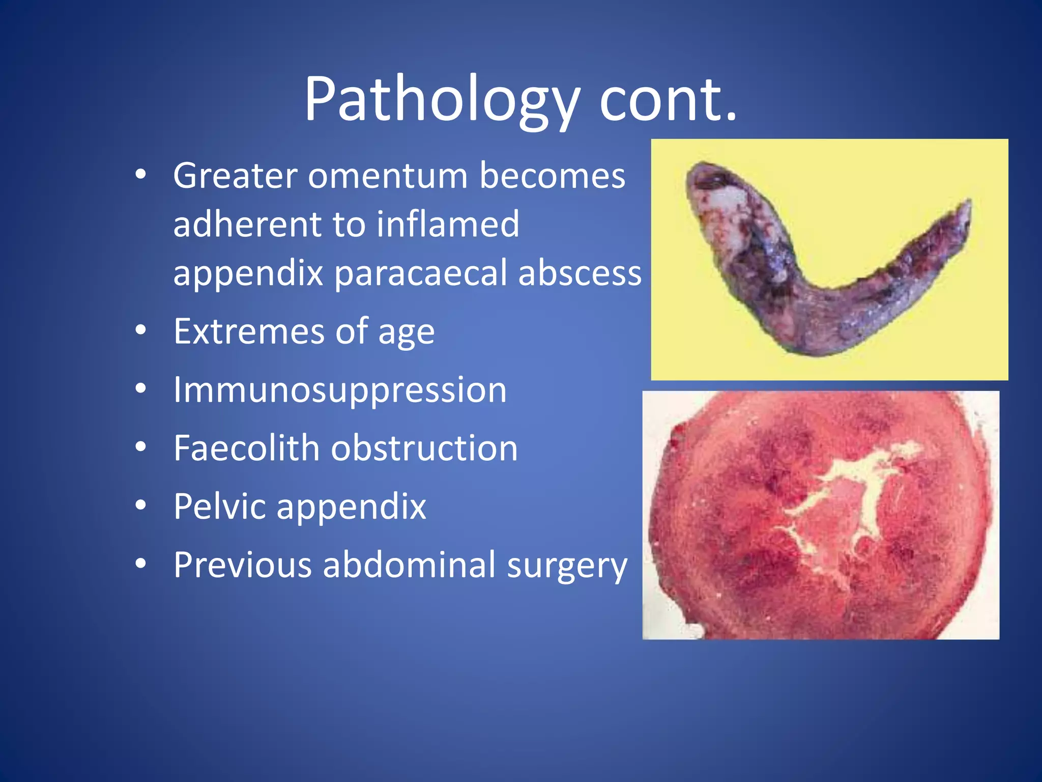 Acute appendicitis &lump | PPTX