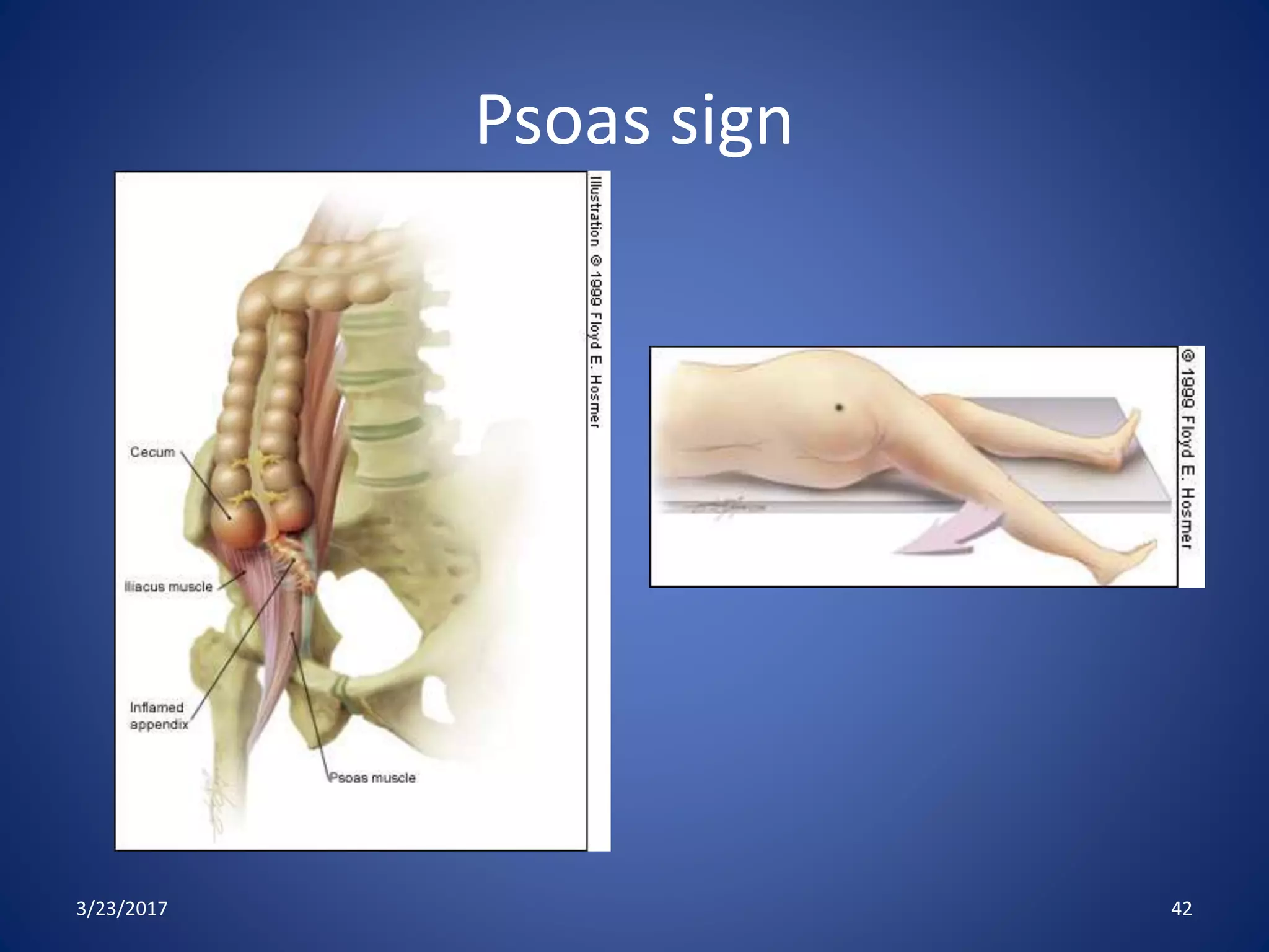 Acute appendicitis &lump | PPTX
