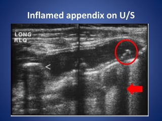 Inflamed Appendix