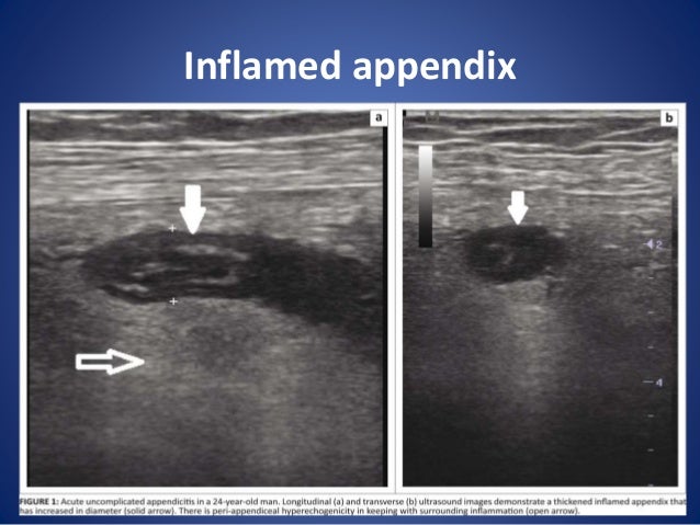 Acute appendicitis &lump