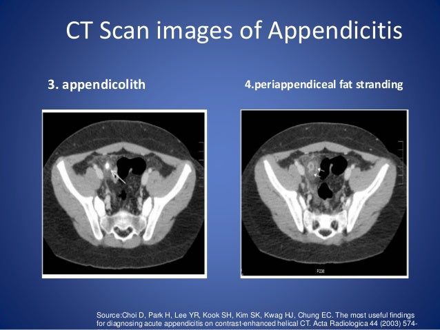 Acute appendicitis &lump