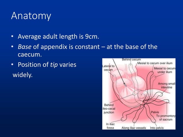 Acute Appendicitis A comprehensive guide.ppt