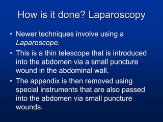Acute Appendicitis A comprehensive guide.ppt