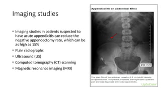 Acute Appendictis diagnosis and management | PPTX