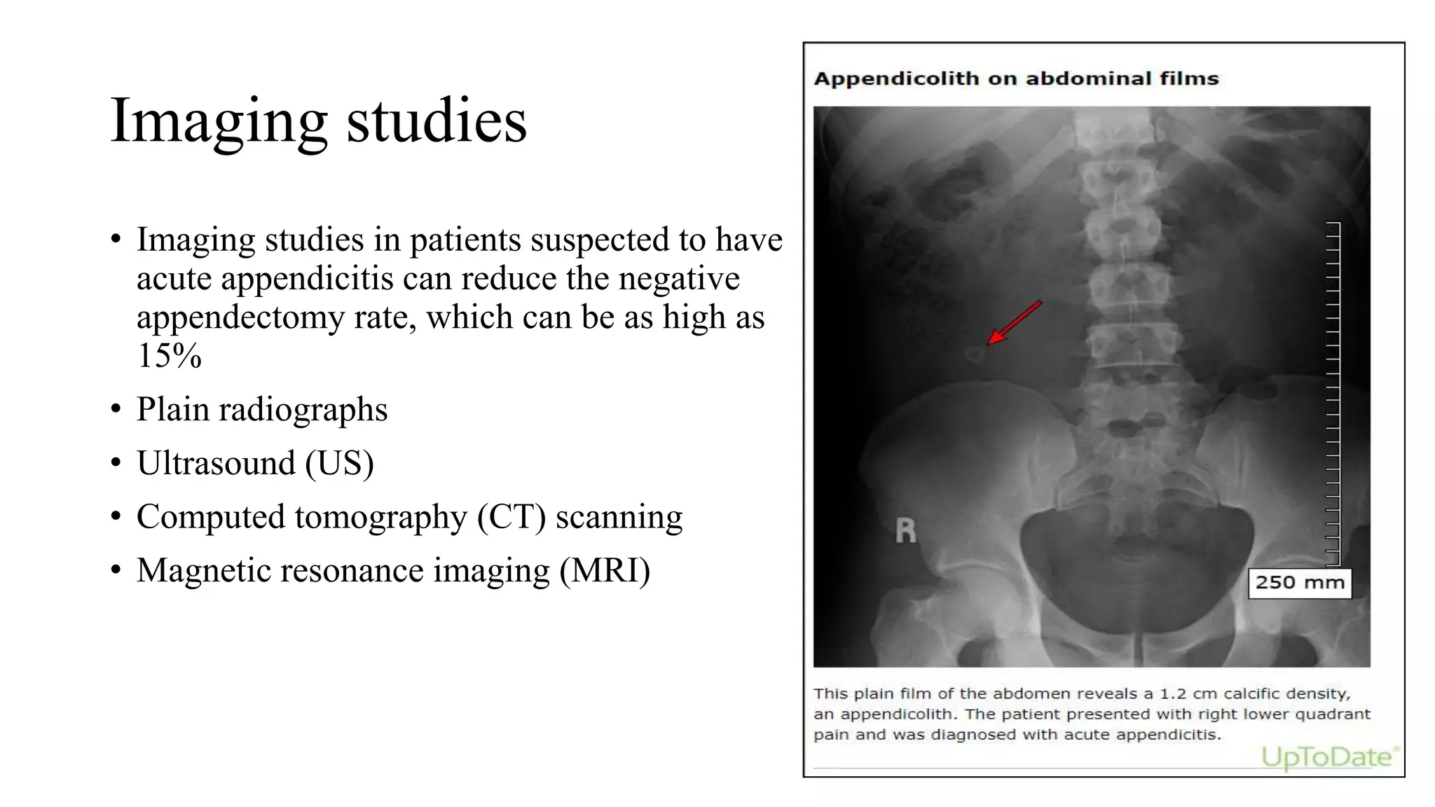 Acute Appendicitis | PPTX