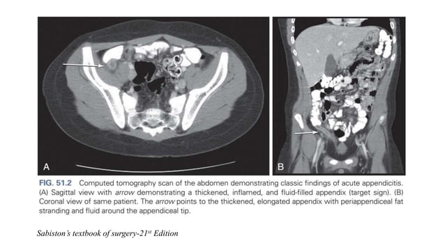 Acute Appendicitis | PPTX