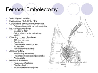 Moore Chapter: Acute Arterial and Graft Occlusion | PPT