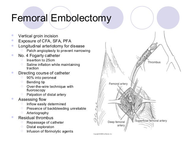 Moore Chapter: Acute Arterial and Graft Occlusion