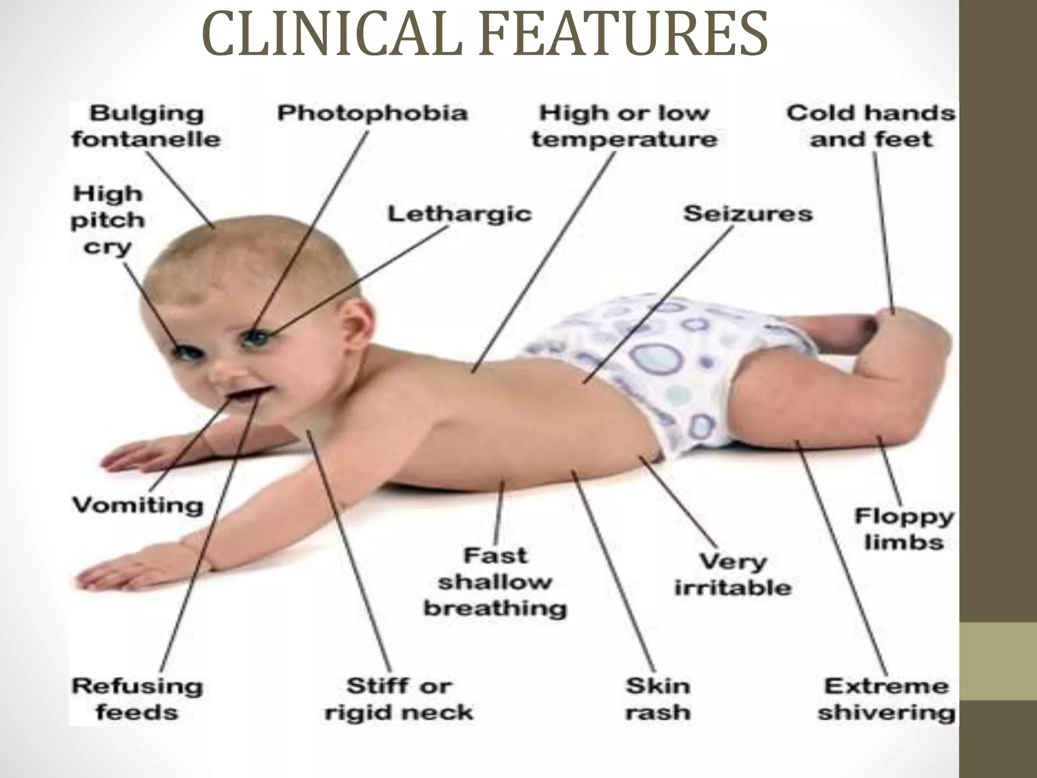 Acute bacterial meningitis - clinical presentation | PPTX