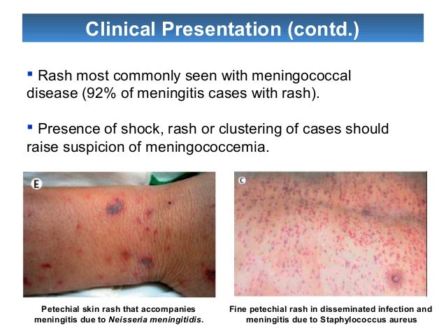 Acute bacterial meningitis seminar swastik
