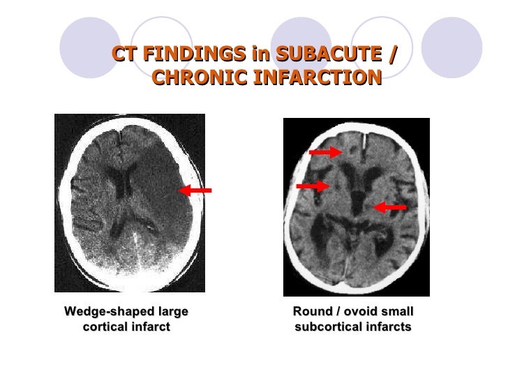 Acute brain attack 911