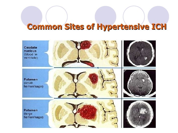 Acute brain attack 911
