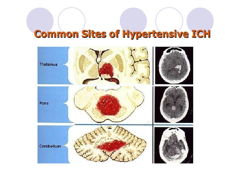 Acute brain attack 911