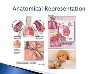 Acute bronchitis in children | PPTX