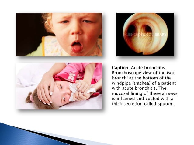 Acute bronchitis in children | PPTX
