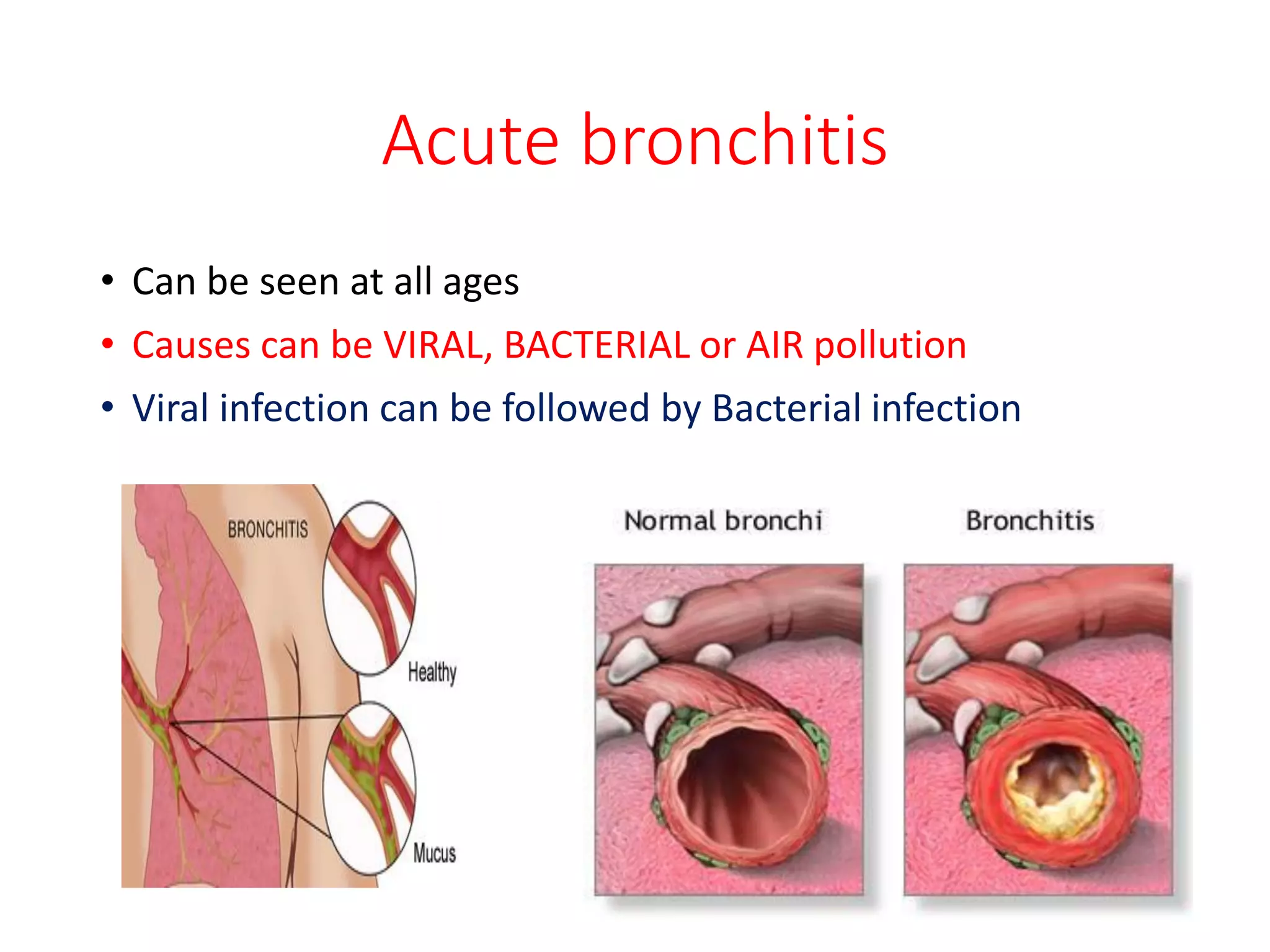 Acute bronchitis in children 2021 | PDF