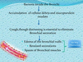 a case presentation on Acute bronchitis | PPTX