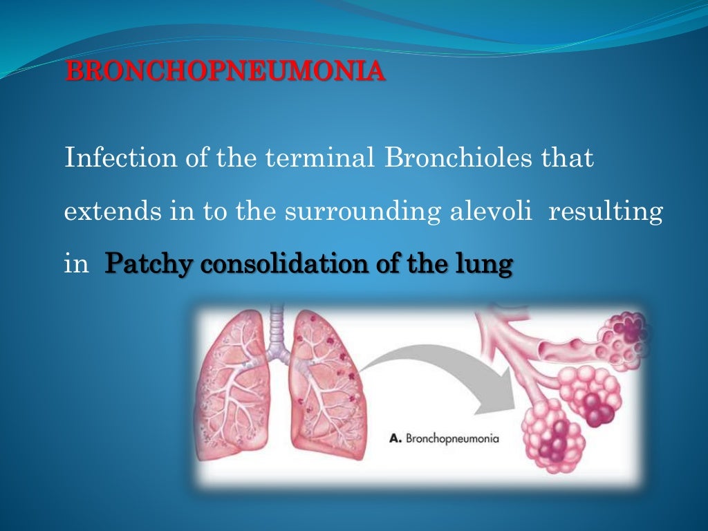 a case presentation on Acute bronchopneumonia