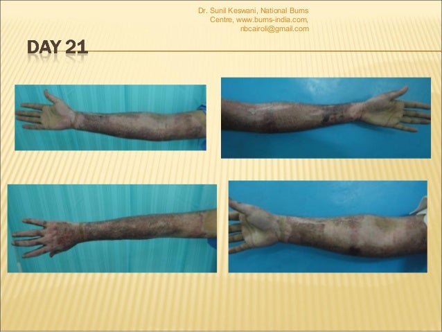Acute burns isshcon 2013 by Dr. Sunil Keswani, National Burns Centre,…