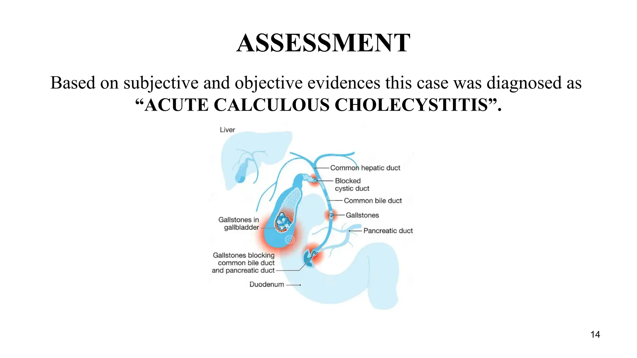 Case on Acute calculous cholecystitis / Case Presentation / PharmD | PPTX