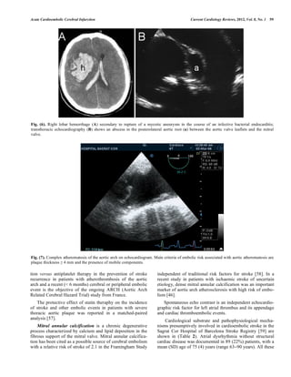 Acute cardioemboli | PDF