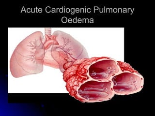 Acute Cardiogenic Pulmonary Oedema - (ACPO) | PPT