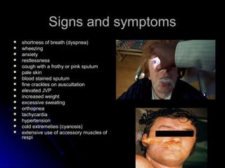Acute Cardiogenic Pulmonary Oedema - (ACPO) | PPT