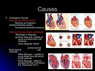 Acute Cardiogenic Pulmonary Oedema - (ACPO) | PPT