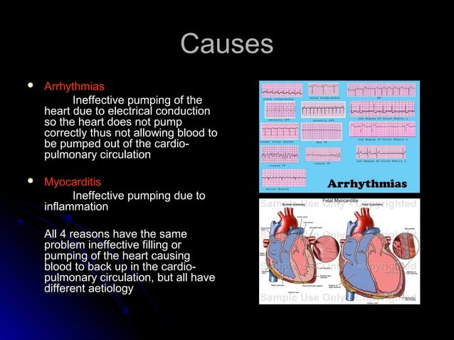 Acute Cardiogenic Pulmonary Oedema - (ACPO) | PPT | Lung and ...