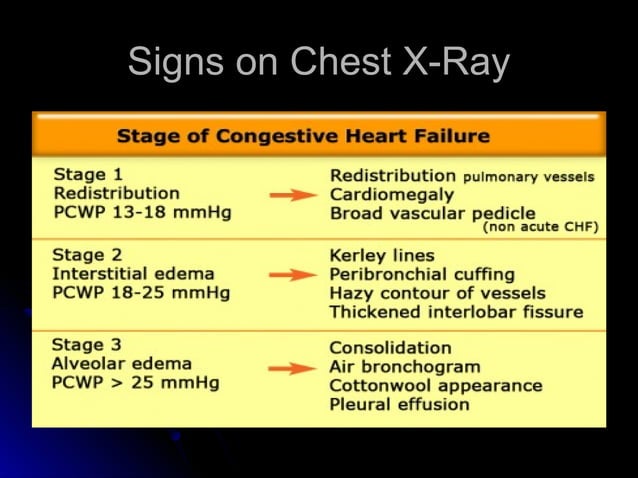 Acute Cardiogenic Pulmonary Oedema - (ACPO)