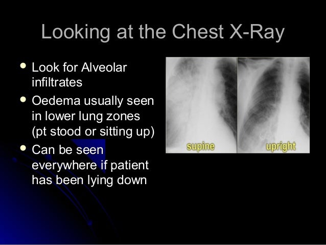 Cardiogenic Pulmonary Edema X Ray