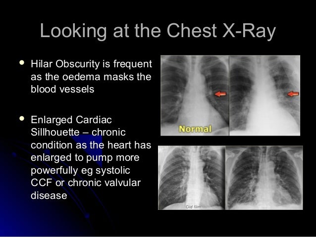 Cardiogenic Pulmonary Edema X Ray
