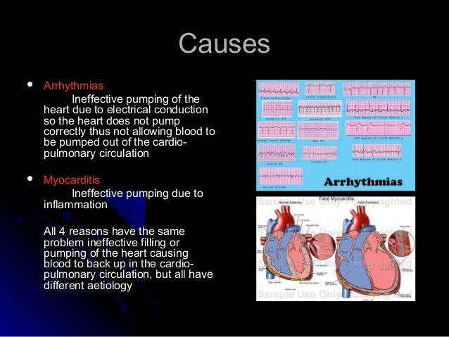 Cardiogenic Pulmonary Edema