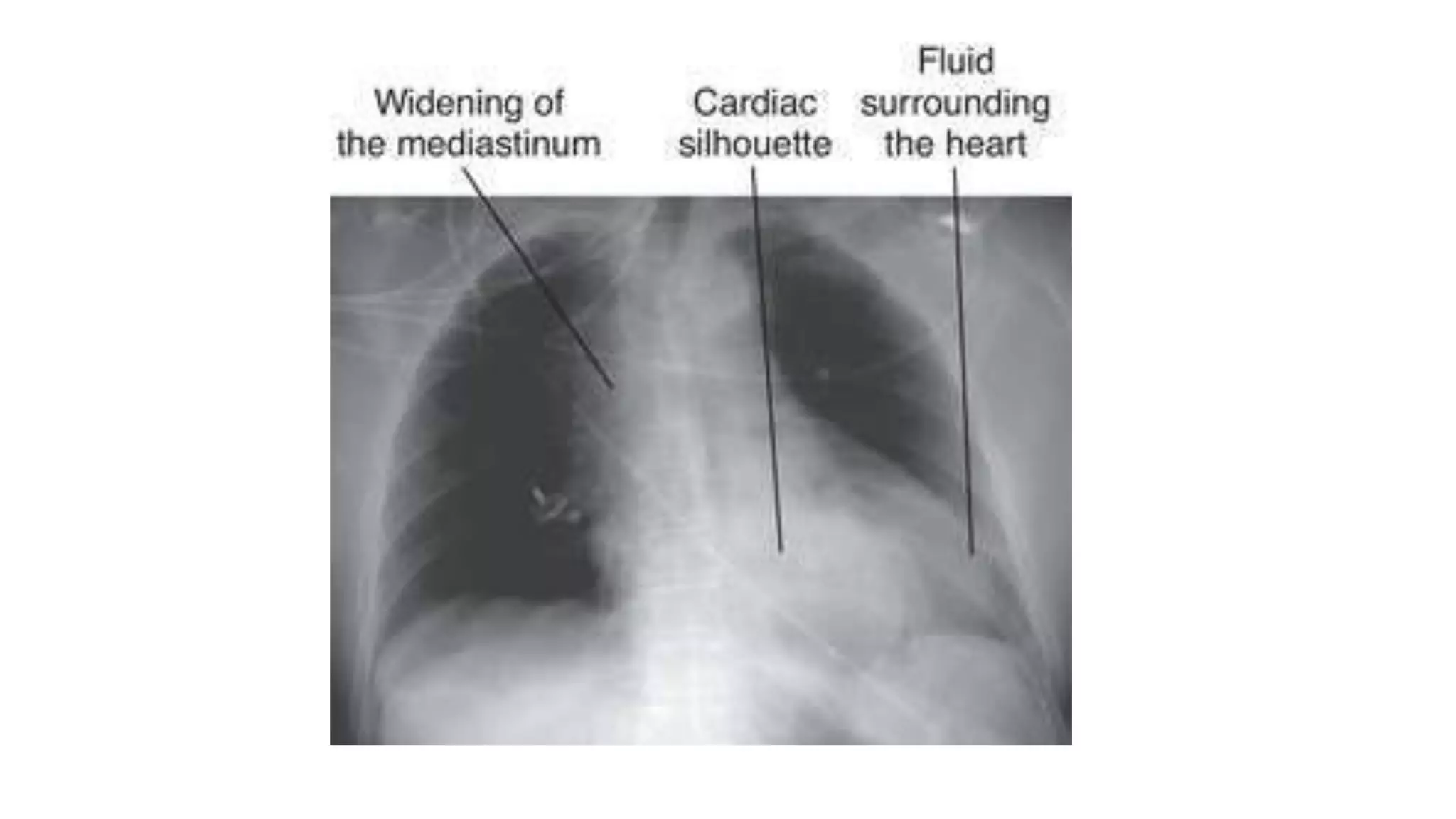 Acute cardiovascular disorders | PPT