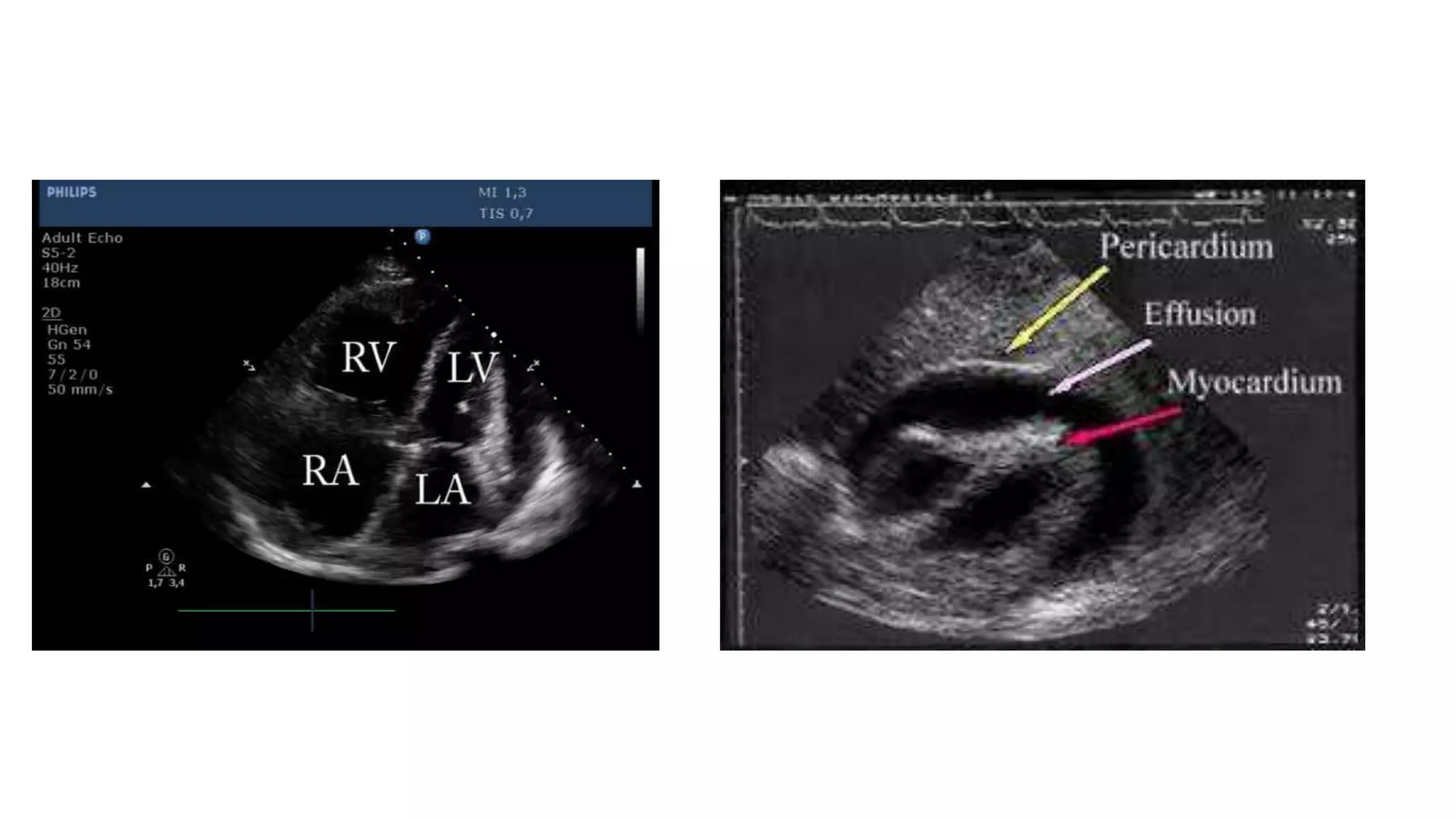 Acute cardiovascular disorders | PPT