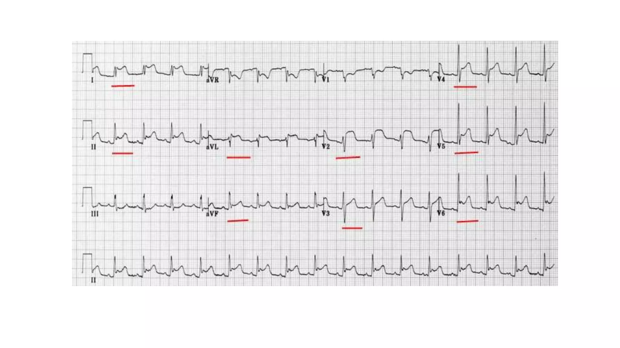 Acute cardiovascular disorders | PPT
