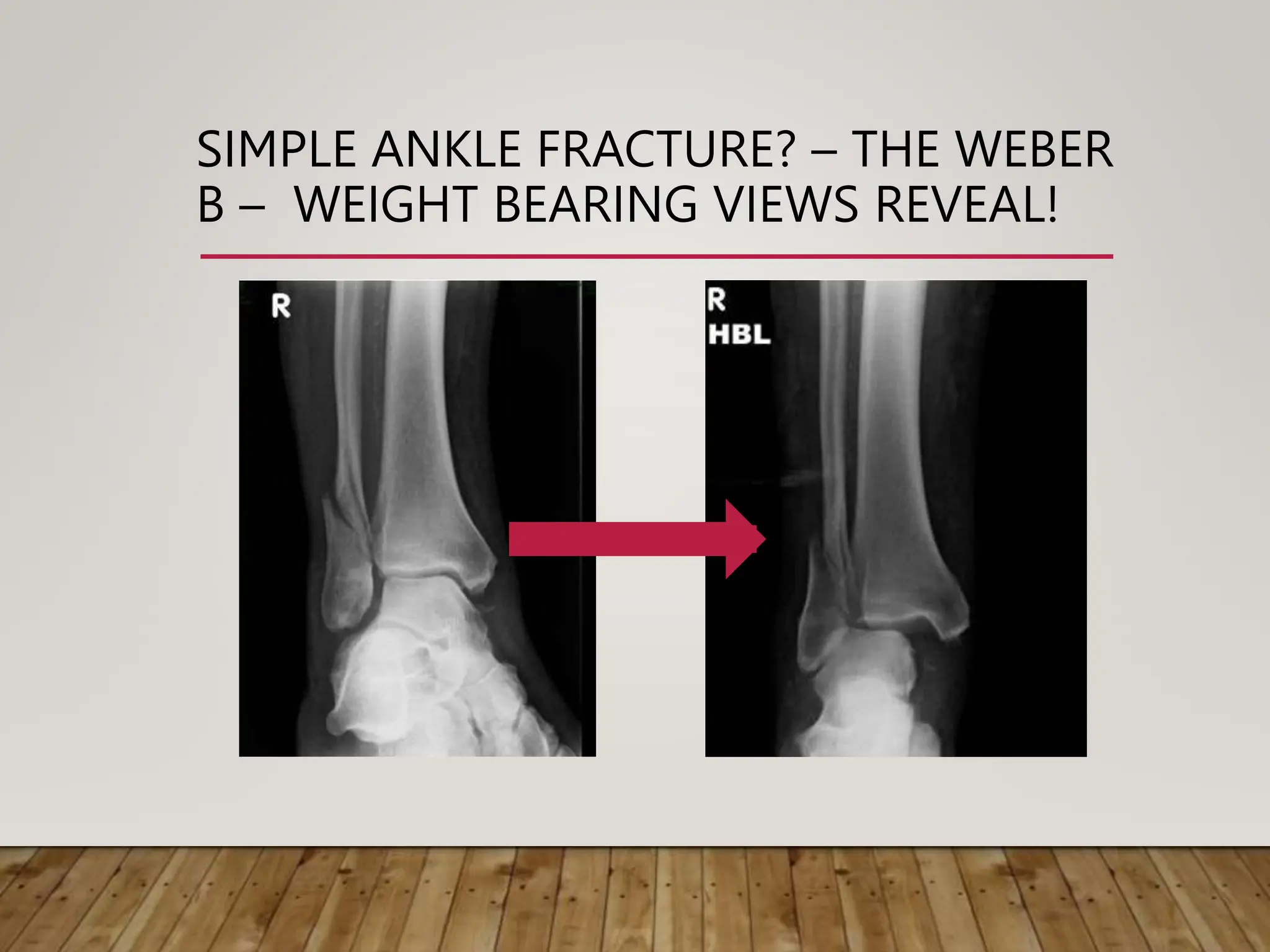 Acute care Ankle Fractures and how to treat them | PPT