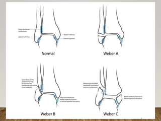 Acute care Ankle Fractures and how to treat them | PPT