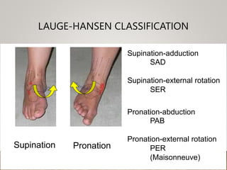 Acute care Ankle Fractures and how to treat them | PPT