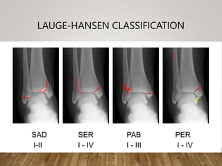 Acute care Ankle Fractures and how to treat them | PPT